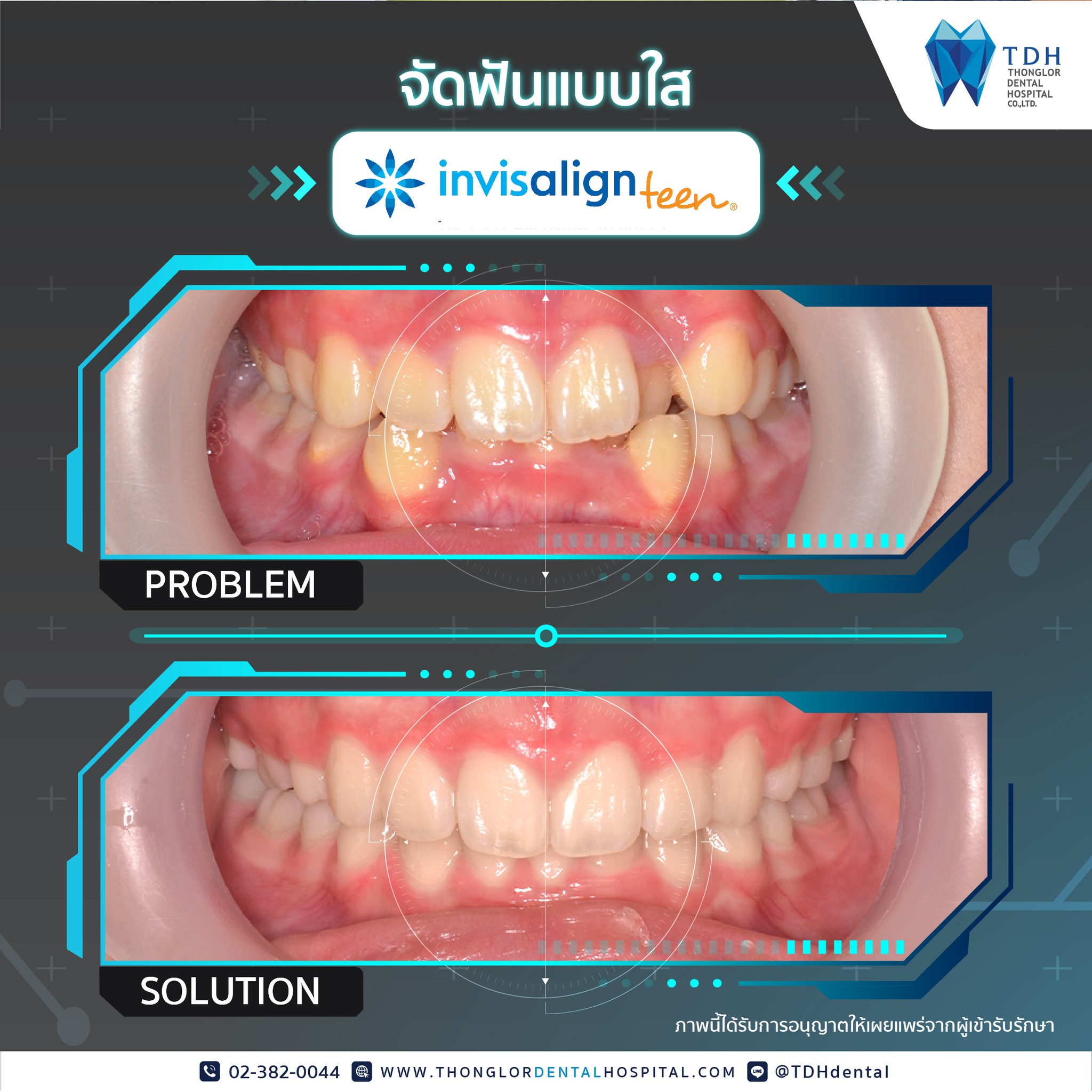 invisalign first and teen - TDH