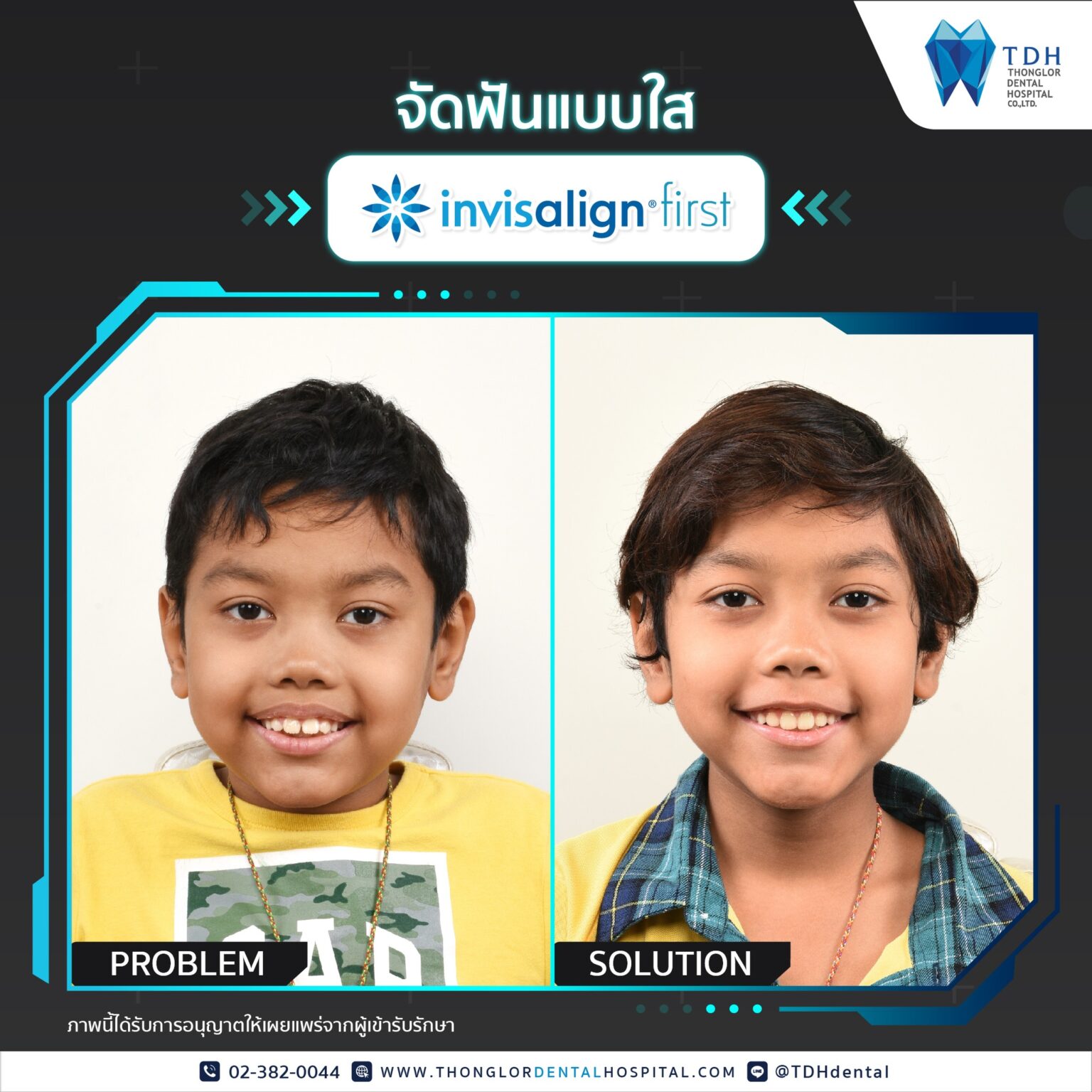 รอยยิ้มสวย เริ่มต้นได้ตั้งแต่เด็ก จัดฟันใส Invisalign First ที่ TDH ...