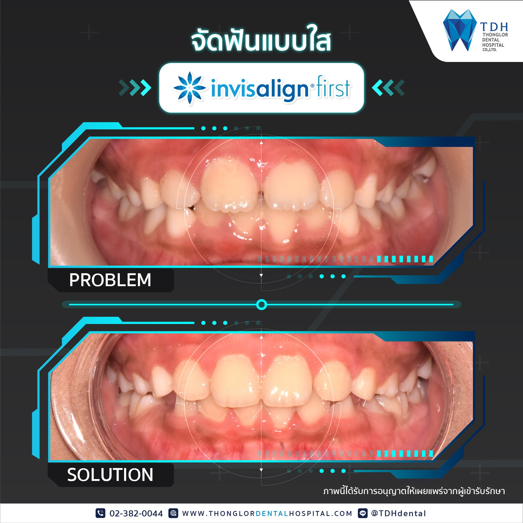 รอยยิ้มสวย เริ่มต้นได้ตั้งแต่เด็ก จัดฟันใส Invisalign First ที่ TDH ...