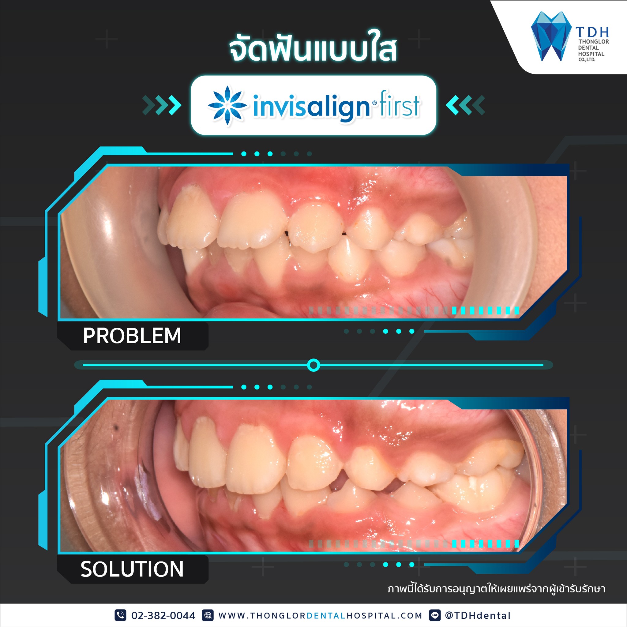 รอยยิ้มสวย เริ่มต้นได้ตั้งแต่เด็ก จัดฟันใส Invisalign First ที่ TDH Dental - TDH