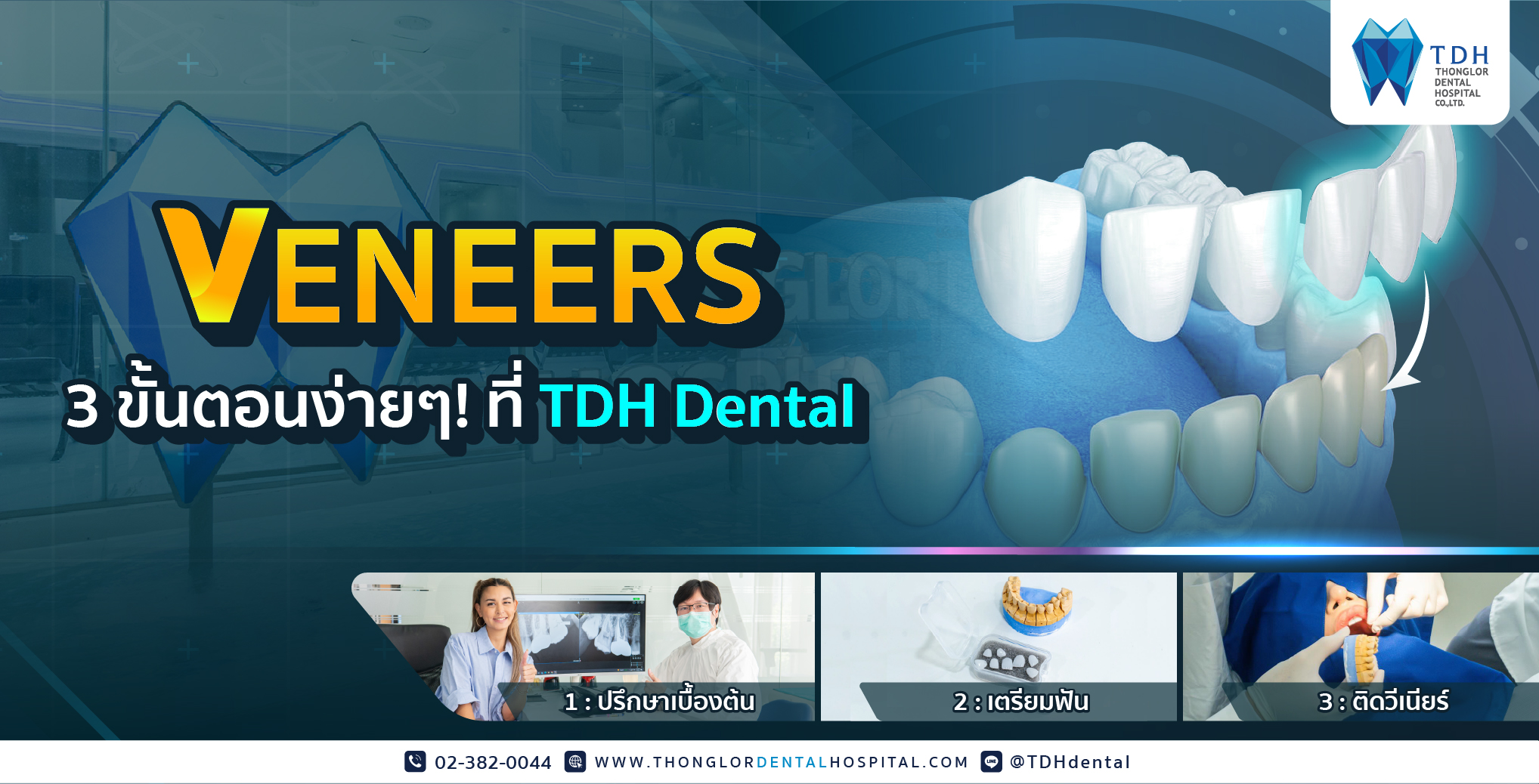 วีเนียร์ใน 3 ขั้นตอนง่ายๆ! ที่ TDH Dental - TDH