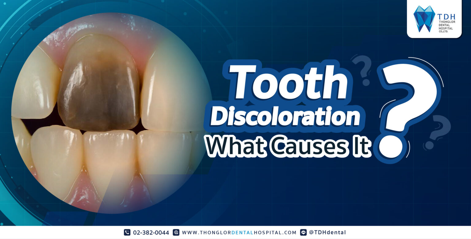 Tooth Discoloration What Causes It? - TDH